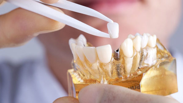 Permanent Dentures – Costs, Pros, and Cons