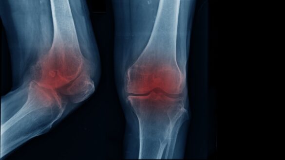 Hyaluronan Injections for Knee Cartilage