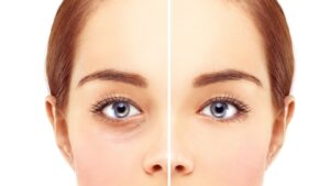 Droopy Eyelid Surgery - Is It Right for You?